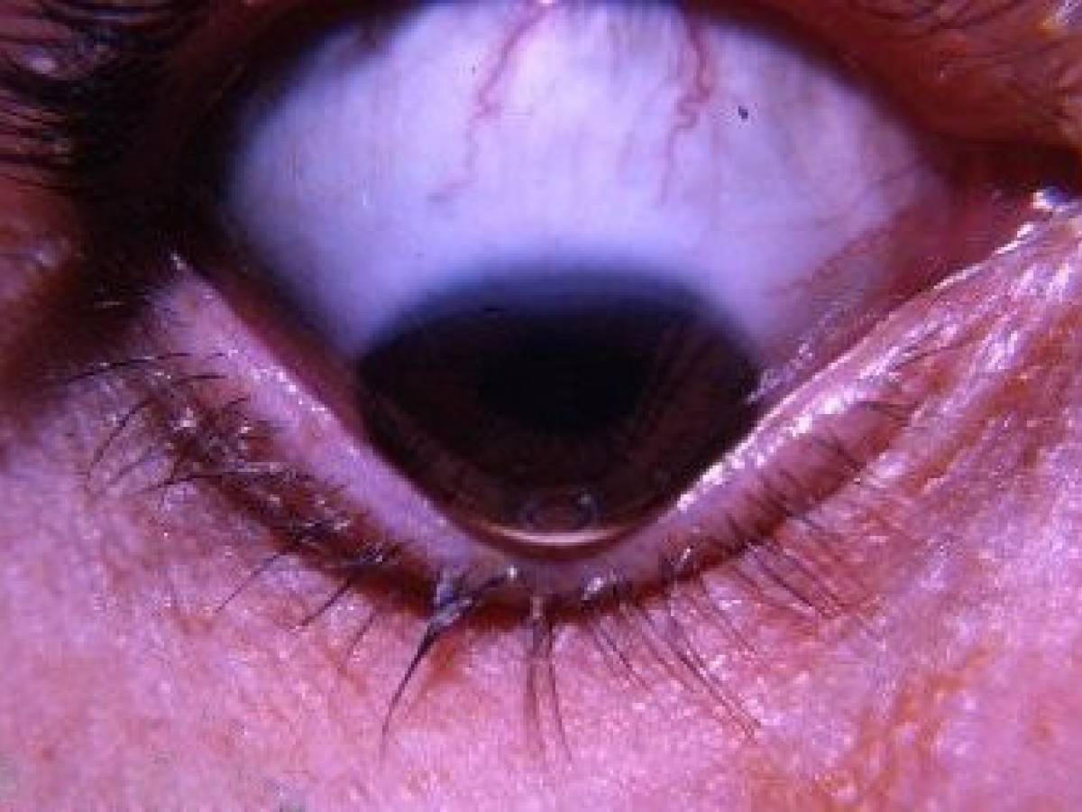 Cheratocono, quali sono i sintomi e come si cura - il Giornale