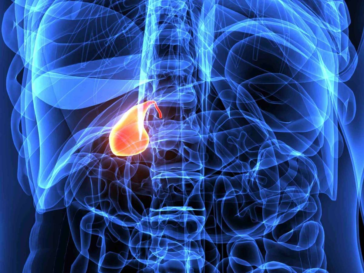 Calcoli biliari: come prevenire la loro formazione con l'alimentazione ...