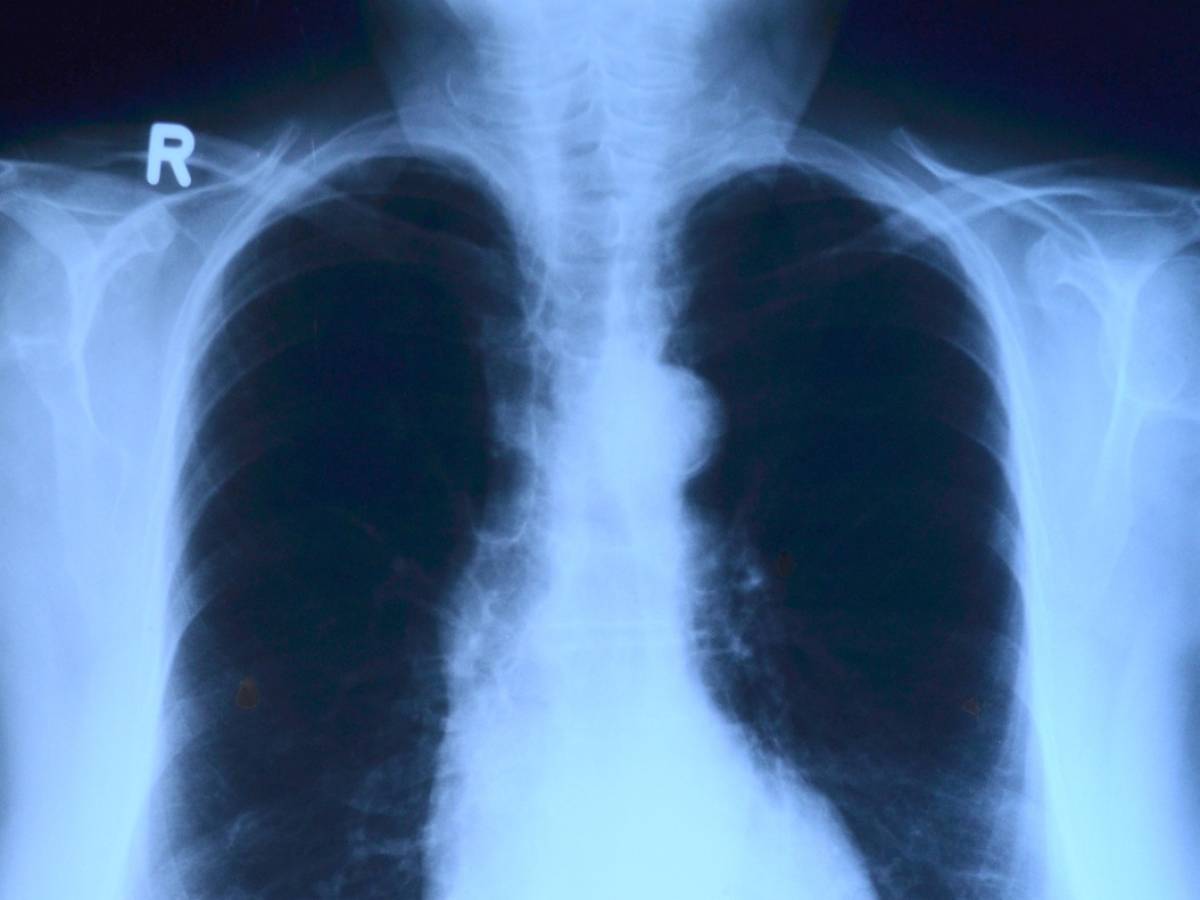 Polmonite batterica, segni e sintomi a cui fare attenzione. Le ...